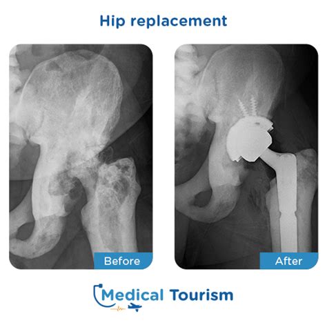 Best Orthopedists For Hip Replacement Medical Tourism International