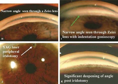 Doczone Interesting Ophthalmology Clinical Photographs Eye Facts