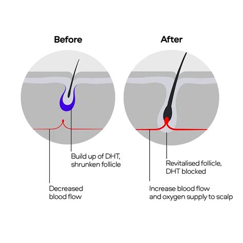 Buy Topical Finasteride And Minoxidil For Hairloss Sons Uk