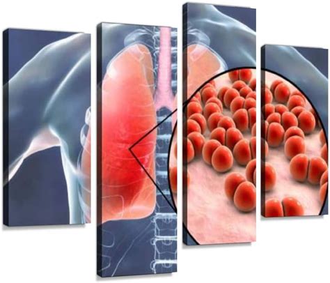 Buy Igoone 4 Panels Canvas Paintings Pneumococcal Pneumonia Medical