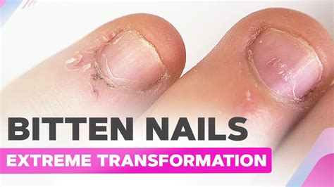 Bitten Nails Extreme Transformation Acrylic System Nail Extension