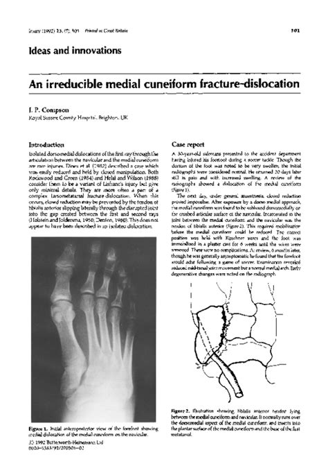 Pdf An Irreducible Medial Cuneiform Fracture Dislocation