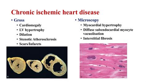Ischemic Heart Disease Pptx
