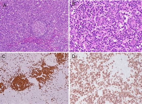 Idiopathic Mcd Plasma Cell Type A A Small Follicle With Attenuated Download Scientific