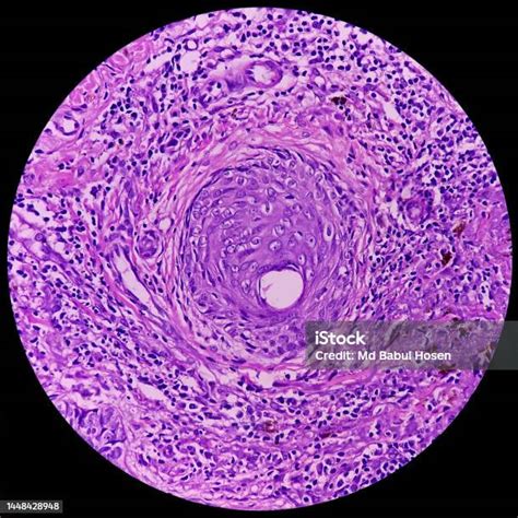 Cheek Tissue Biopsy Basal Cell Carcinoma Show Skin Malignant Neoplasm