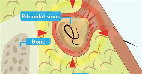 Pilonidal Sinus Understanding Causes Symptoms And Treatment Options