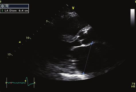Left Parasternal Long Axis View Shows Severely Enlarged Left Atrium At Download Scientific