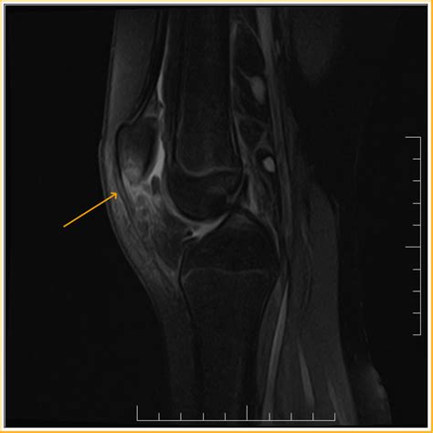 Lateral Patellar Dislocation Sumers Radiology Blog