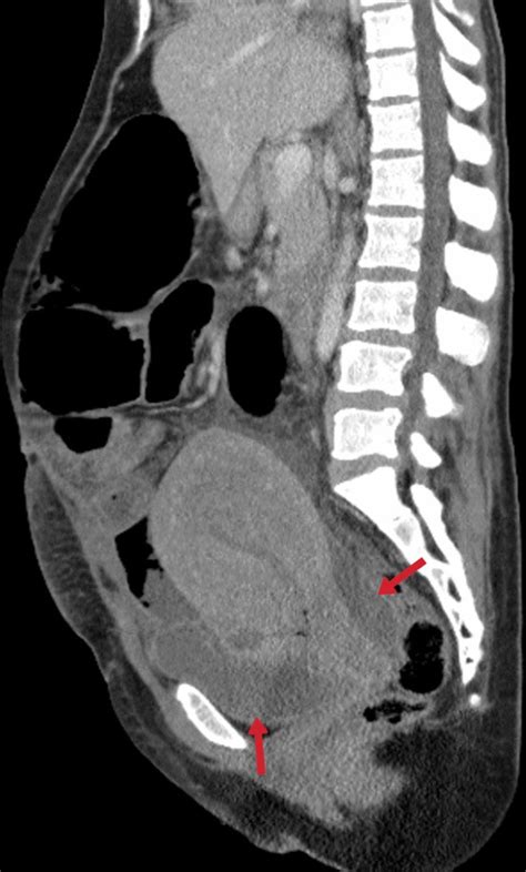 Acute Pyogenic Pelvic Inflammatory Disease As A Late Sequelae Of Perforated Appendicitis Pacs