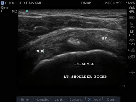 Shoulder Ultrasound Pathology