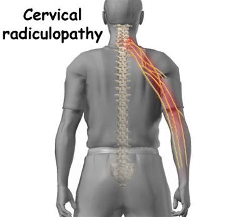 Cervical Radiculopathy Treatment In Noida Greater Noida Delhi Ncr