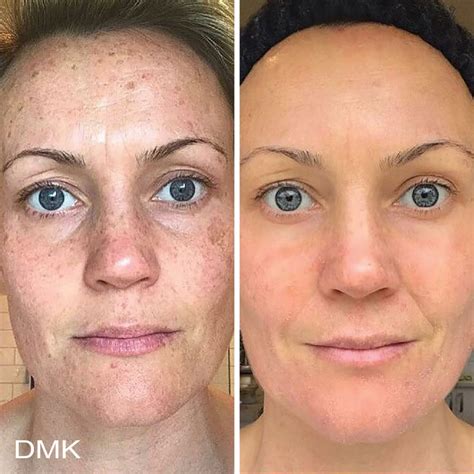Dmk Enzyme Therapy Hollywoods Skincare Secret