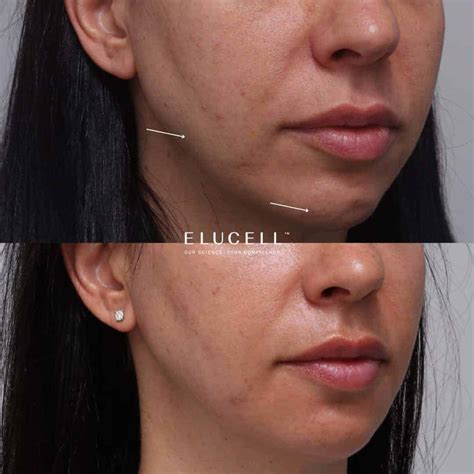 Pdo Mono Threads For Rejuvenation Your Comprehensive Guide Elucell