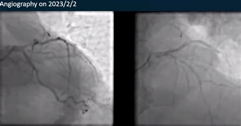 振興心知識chenghsingeneralhospitalcv Pci Lcx Stumpless Cto Rca Retrograde 振興心知識chenghsingeneralhospitalcv Pci Lcx Stumpless Cto Rca Retrograde