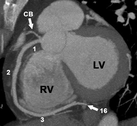 Cardiac Ct In Emergency Department Patients With Acute Chest