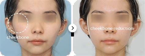 Achieve Facial Balance With Cheekbone Reduction Surgery