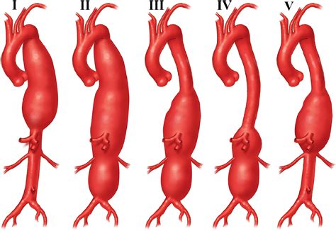 How We Would Treat Our Own Thoracoabdominal Aortic Aneurysm Journal