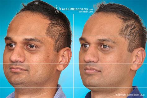 Deep Bite Correction No Surgery Braces Or Tooth Grinding