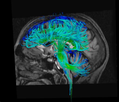 Dtmri Diffusion Tensor Mri Visualization In The 3d Slicer