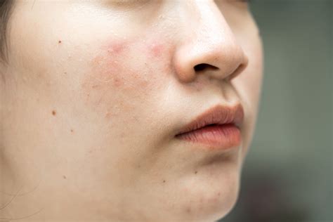 Rash On Face Contact Dermatitis Causes Symptoms And Treatment