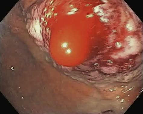 Immediate Postpolypectomy Bleeding Download Scientific Diagram
