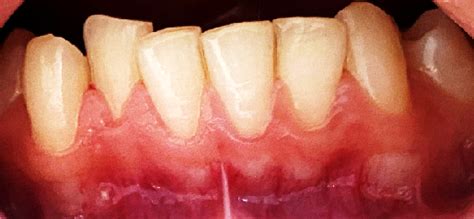 Visual Method For Detecting Mucogingival Junction 2 Tension Test Tt Download Scientific