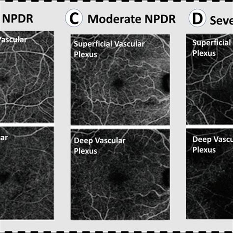 Oct Angiograms Across Varying Severities Of Diabetic Retinopathy A