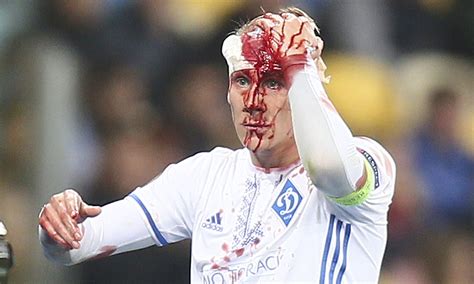 Worst Soccer Injuries Of All Time
