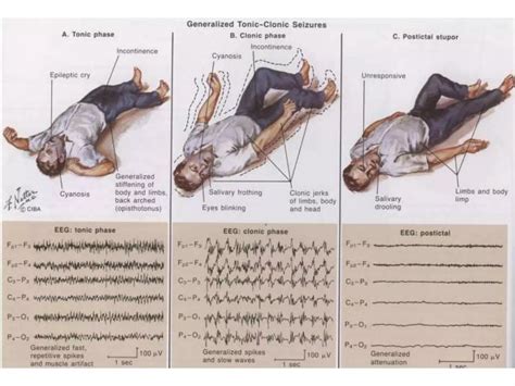 Diagrams Eeg Epilepsyppt