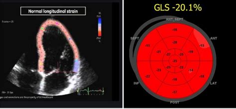 Limitations Of Gls Echo Drsvenkatesan Md