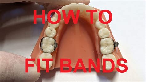 Ortho Band Placement At Mary Bilbo Blog