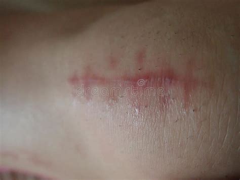 Scar After Operation On A Leg Stock Image Image Of Surgeon Medical