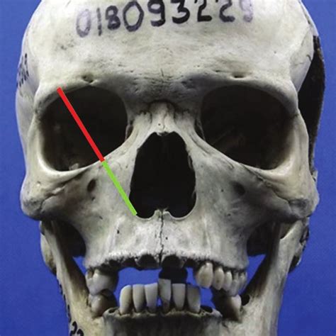 Maxilla And Mandible There Is An Increase In Maxillary Resorption With