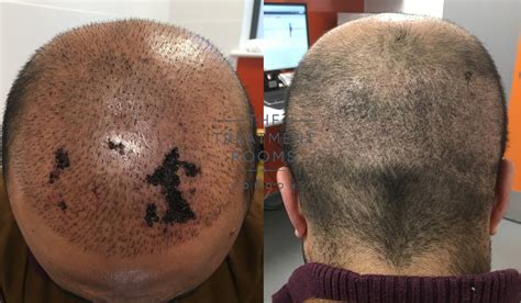 Scalp Inflammation After Hair Transplant At Nicholas Warrior Blog