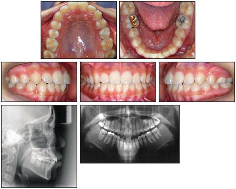 Impacted Maxillary Second Molars