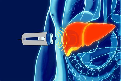 What Is Fibroscan A Helpful Guide To Your Liver Health Scan Clinic