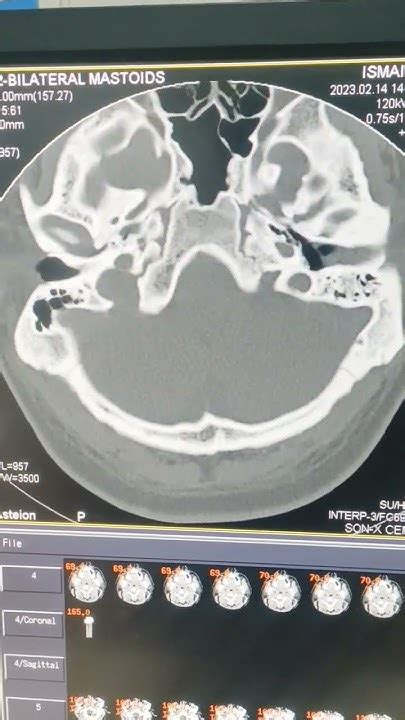 Ct Scan Bilateral Mastoid Chronic Mastoiditis 1 Mm Thickness With 4