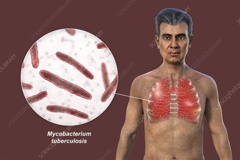 Lungs Affected By Miliary Tuberculosis Illustration Stock Image F038 6529 Science Photo