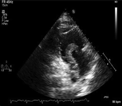Submassive Pulmonary Embolism Circulation
