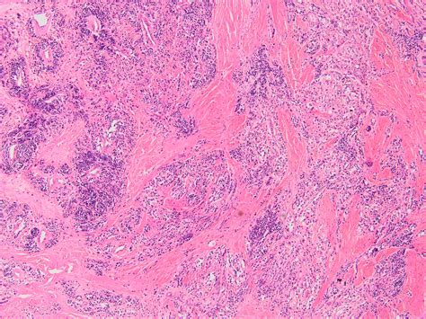 Pathology Outlines Clear Cell Sarcoma Of Soft Tissue