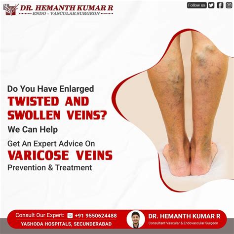 Dr Hemanth Kumar On Linkedin Varicoseveins Drhemanthkumar Vascularsurgery Endovascularsurgery