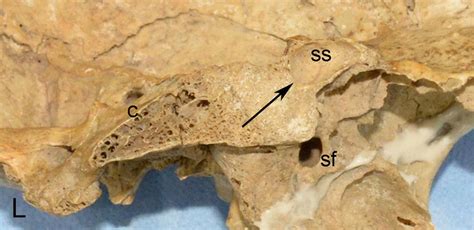 The Pneumatization Of Sphenoidal Sinus Was Presellar Type— Arrow And Ss