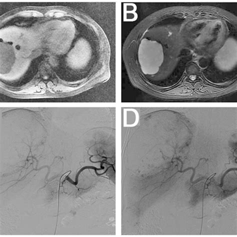 Ct Plain Scan An Oval Low Density Lesion With Clear Boundaries And Download Scientific