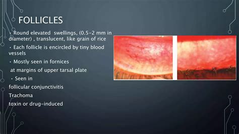 Common Conjunctival Conditions Pptx