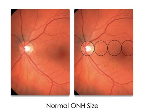 Block 17 Glaucoma Flashcards Quizlet