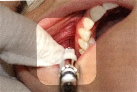 Chapter 11 And 12 Basic Injection Techniques And Maxillary Injections