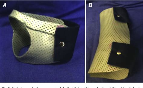 Figure From Dart Splint An Innovative Orthosis That Can Be Integrated Into A Scapho Lunate