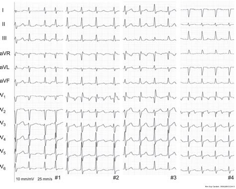 Atypical Atrial Flutter And Ablation Of Recipient To Donor Atrioatrial