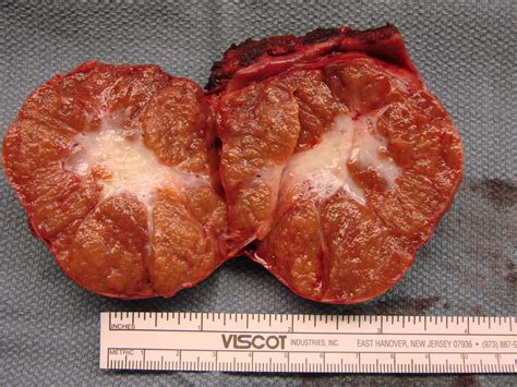 Focal Nodular Hyperplasia Gross Liver Atlas Case 200 Focal Nodular