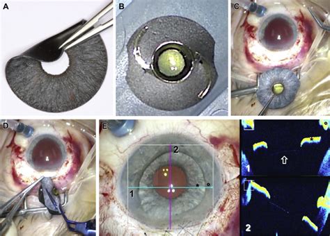 Pupillary Reconstruction And Outcome After Artificial Iris Implantation